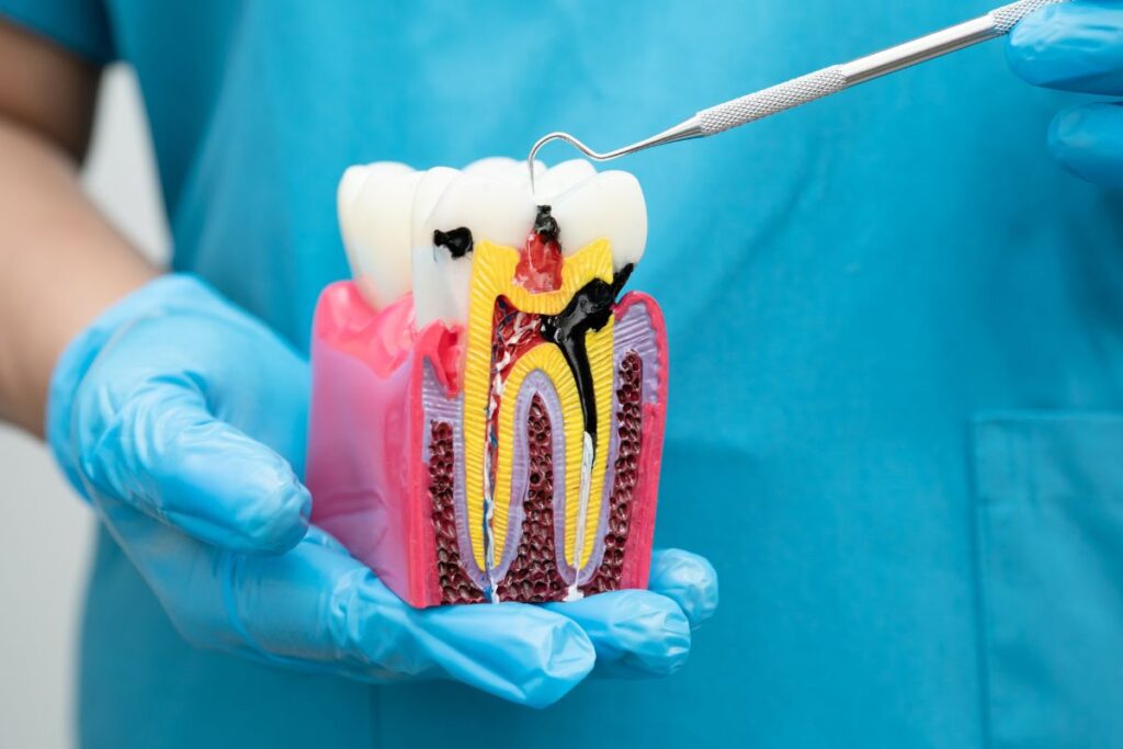 What Happens If You Don’t Get a Root Canal – Know the Risks